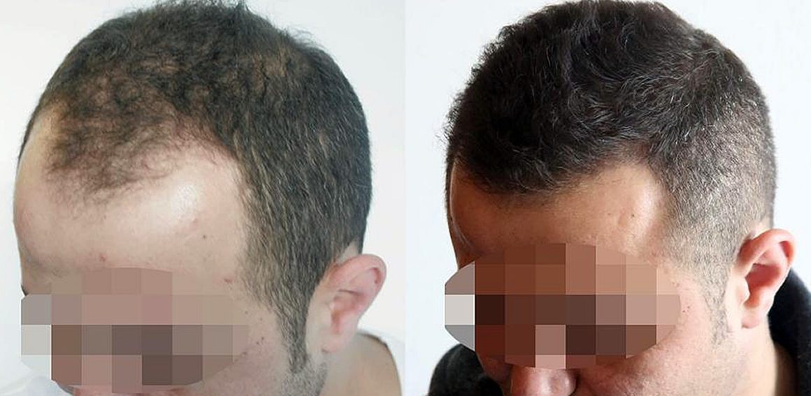 hCRP Capelli Brescia, differenze con PRP HT e PRF. - HairClinic.it