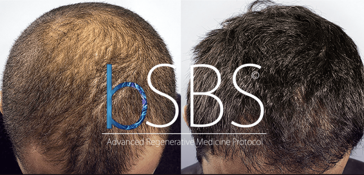 hCRP Capelli L'Aquila, PRP Capelli si evolve in hCRP. - HairClinic.it