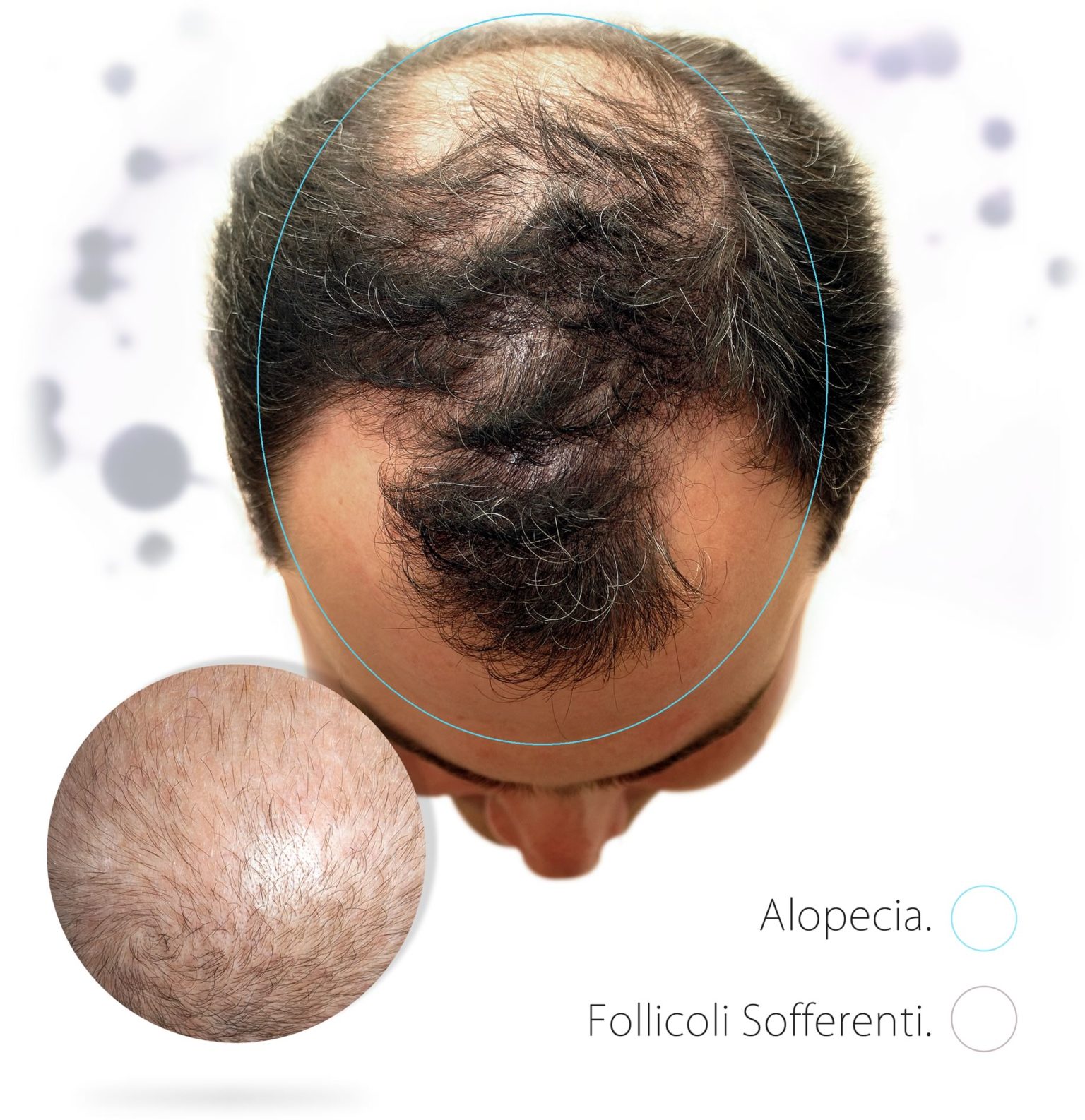 Finasteride Topica o in gel? Uso, rischi e risultati. - HairClinic.it