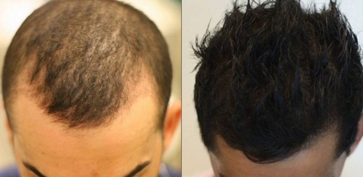 PRP Capelli Verona: hCRP evolve contro la calvizie. - HairClinic.it