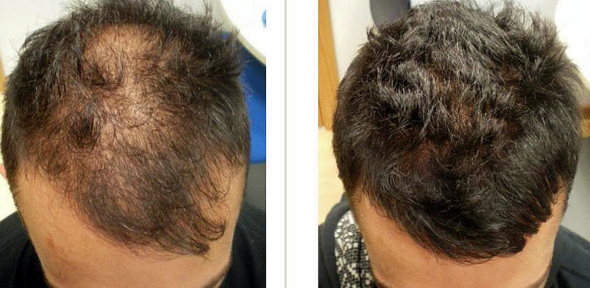 Finasteride Topica o in gel? Uso, rischi e risultati. - HairClinic.it