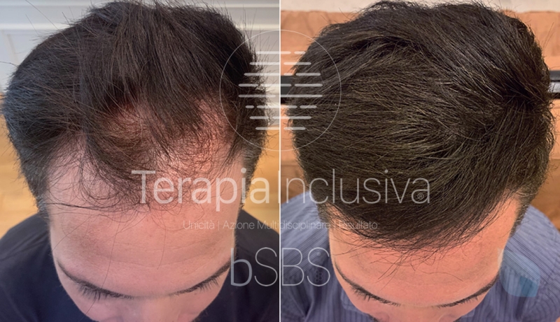 Protocollo bSBS: come prepararsi alla sessione | Hairclinic